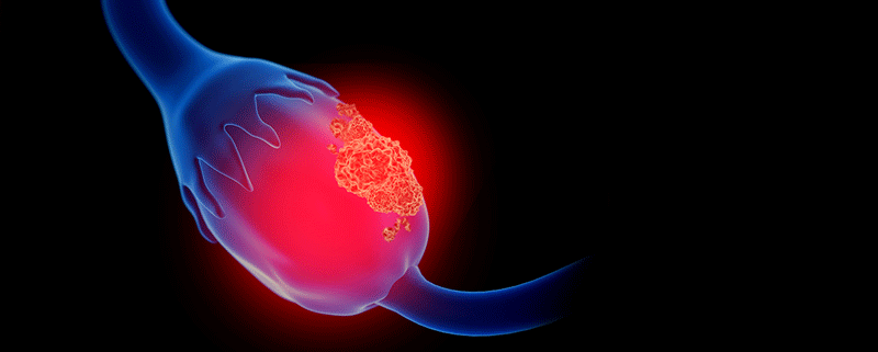 FANCI: new gene at origin of some cases of ovarian cancer | Mirage News