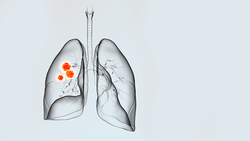 New Advances In Lung Cancer Treatment Mirage News