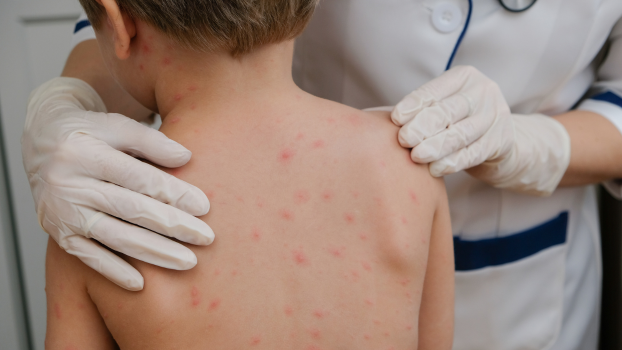 Important notice: Potential exposure to chickenpox at the Montreal ...