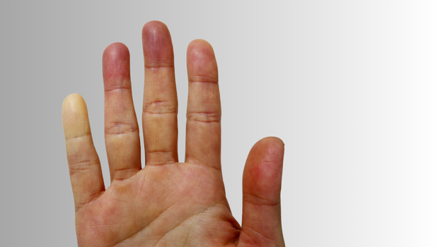 New approach to treating severe finger lesions | McGill University ...