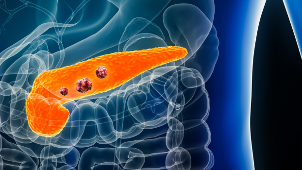 ‘Jumping gene’ helps explain elevated pancreatic cancer risk in French ...