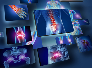 New treatments and finding for osteoporosis | McGill University Health ...